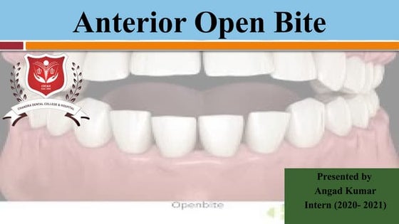 TREATMENT OF OPEN BITE with use of orthodontic appliances | PPT