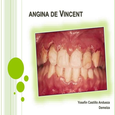 Angina de vincent - modelos unicausal y multicausal | PPTX