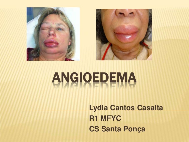 Angioedema