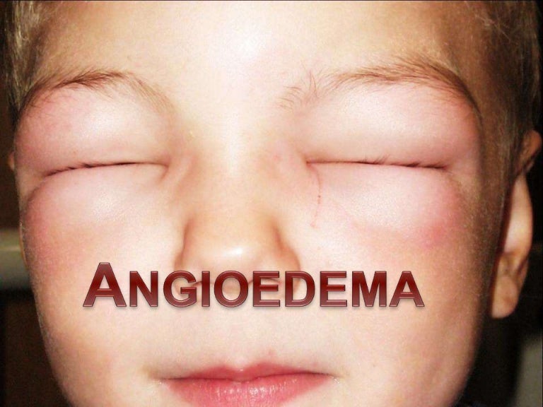 Angioedema