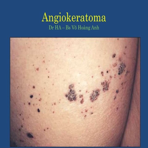 (Dr HA) Angiokeratoma - U Mạch Sừng Hóa / Bs Võ Hoàng Anh | PPTX