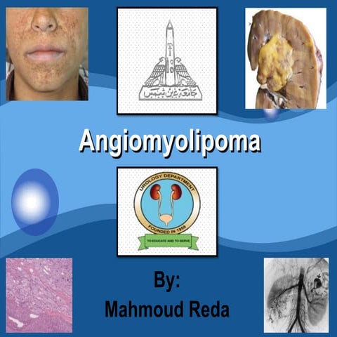 Ain-shams University,Urology department, ,Angiomyolipoma, by Mahmoud ...