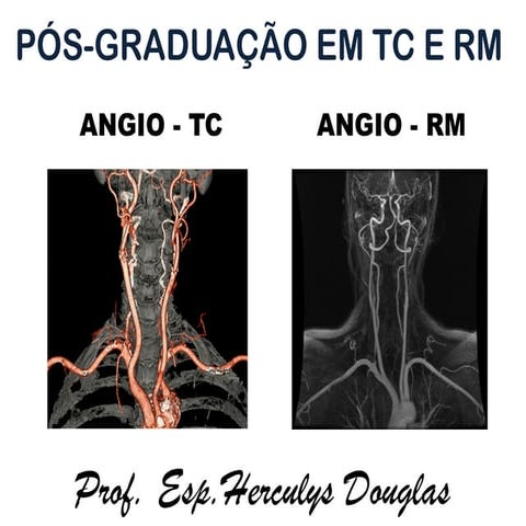 ANGIO: TOMOGRAFIA E RESSONÂNCIA MAGNÉTICA | PPT