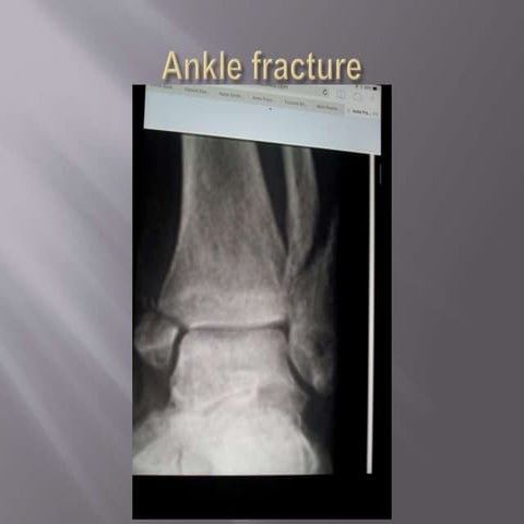 Ankle fracture (2).pptx