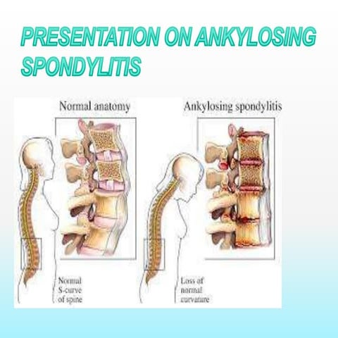 Ankylosing spondylitis | PPT