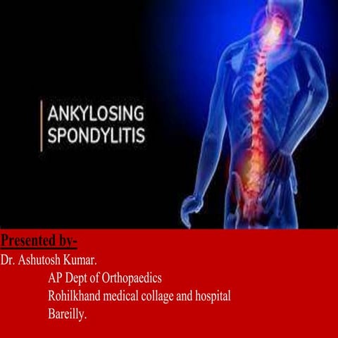 Ankylosing spondylitis by dr ashutosh | PPT