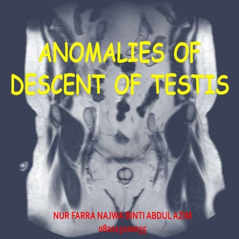 Anomalies of descent of testis | PPTX