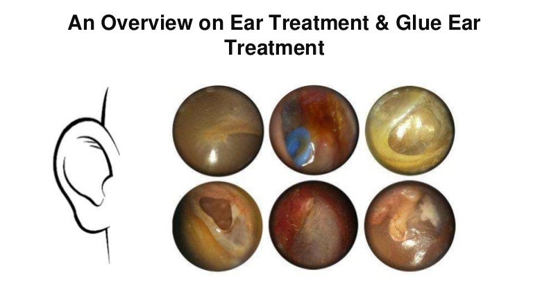 An overview on ear treatment & glue ear treatment