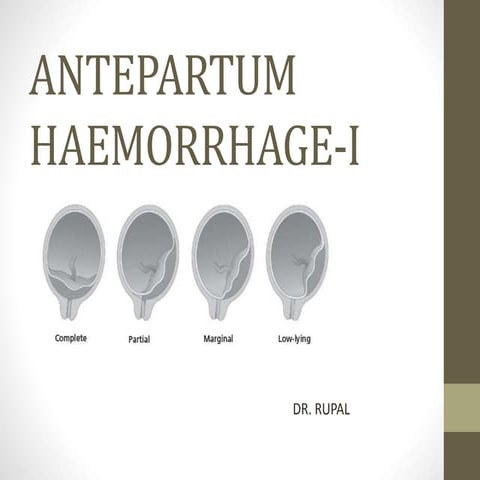 Antepartum haemorrhage | PPT