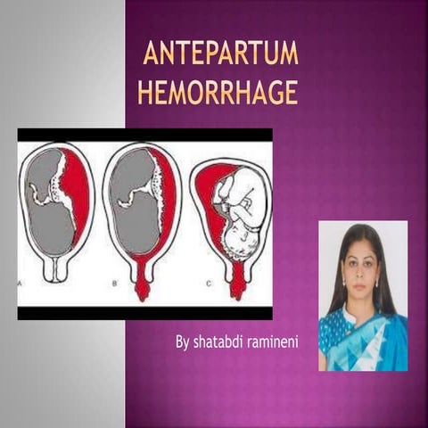 antepartum hemorrhage.pptx