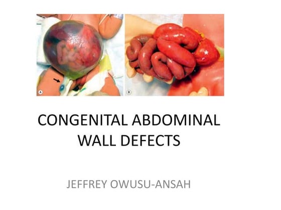 Diverticulitis and its nursing management.ppt