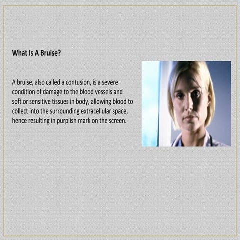 Bruises - Causes, Symptoms & Natural Treatments | PPT