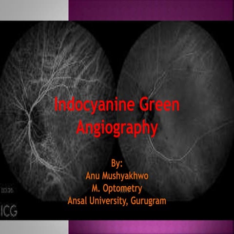 Indocyanine Green Angiography (ICG) | PPTX