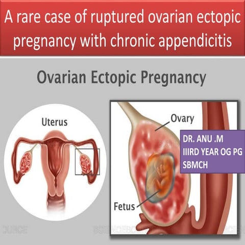 A RARE CASE PRESENTATION OF OVARIAN ECTOPIC PREGNANCY | PPTX