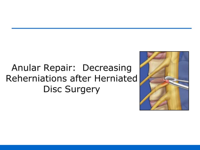 Herniated Disc Surgery( Gowtham 303).pdf