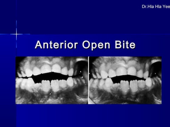TREATMENT OF OPEN BITE with use of orthodontic appliances | PPT