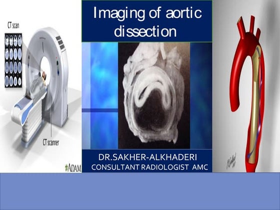 Aortic dissection | PPT