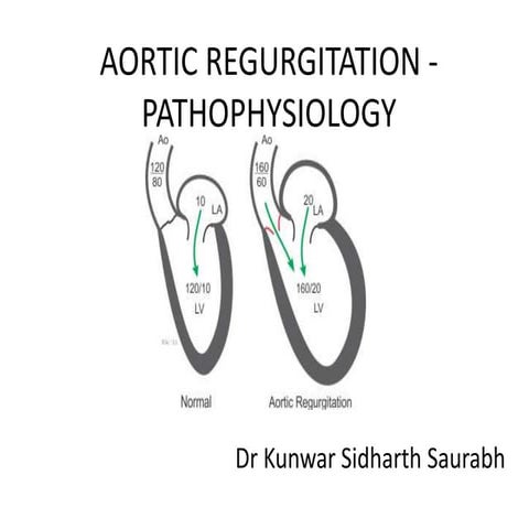 Aortic regurgitation pathophysiology | PPT