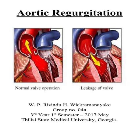 Aortic Regurgitation Expert Proposal To Analyze The Combination Of