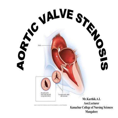 Aortic stenosis | PPT