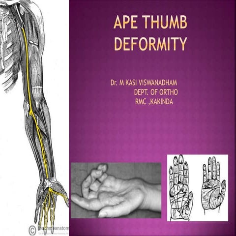 Ape thumb deformity to publish | PPTX