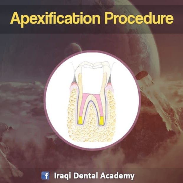 Apexification Procedure - Pediatric Dental Lecture | PDF