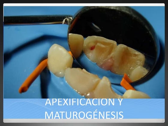 Apexogenesis & apexification | PPTX | Dental Health | Diseases and ...