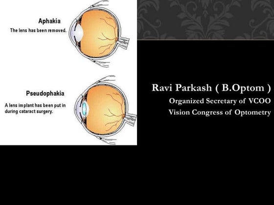Pseudophakia | PPTX | Eye and Vision Conditions | Diseases and Conditions