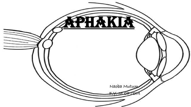 Aphakia and pseudophakia | PPTX