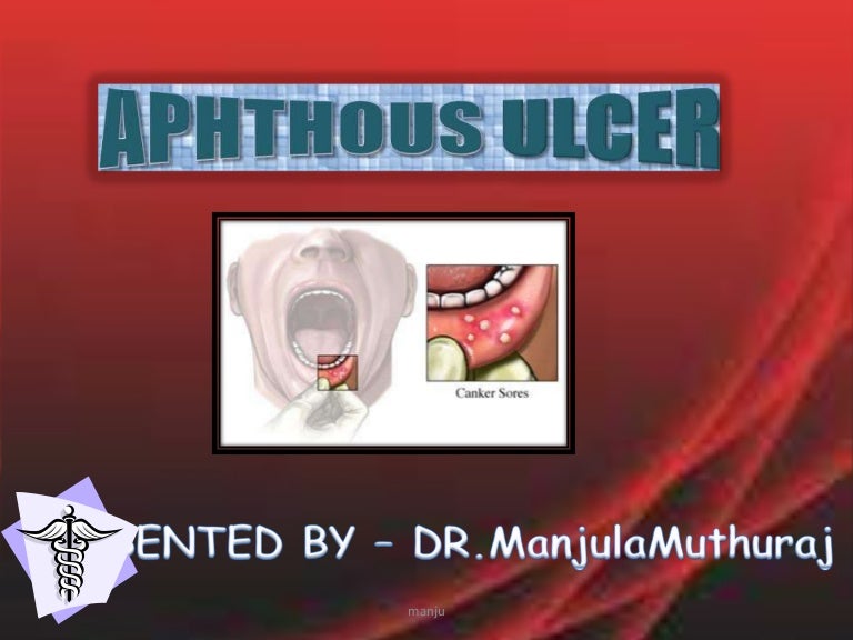 Aphthous Ulcer