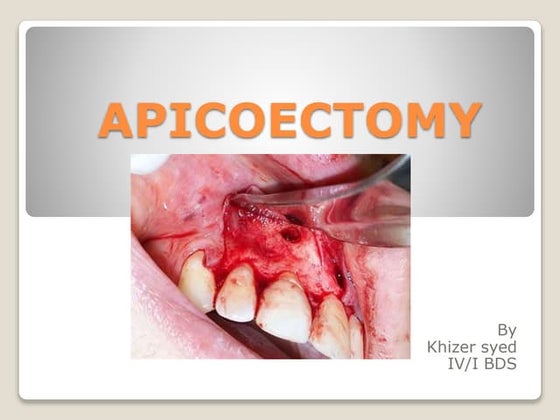 Dental implant instruments | PDF