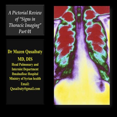A pictorial review of “signs in thoracic imaging 01” | PPT