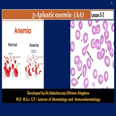 Aplastic anemia (aa) | PPT