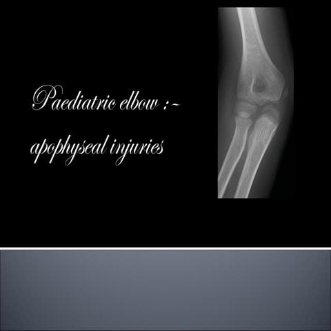 Apophyseal injuries of elbow , medial epicondyle avulsion fractures ...
