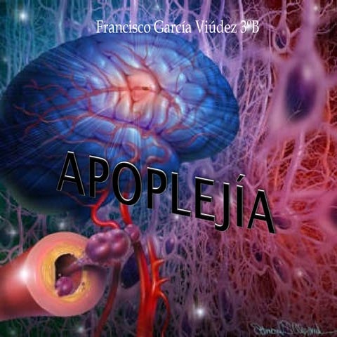 Apoplejía.. | PPT