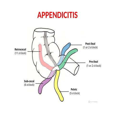 APPENDICITIS AND ITS MANAGEMENT......... | PPTX