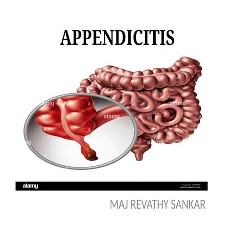ACUTE APPENDICITIS PPT [Autosaved].pptx