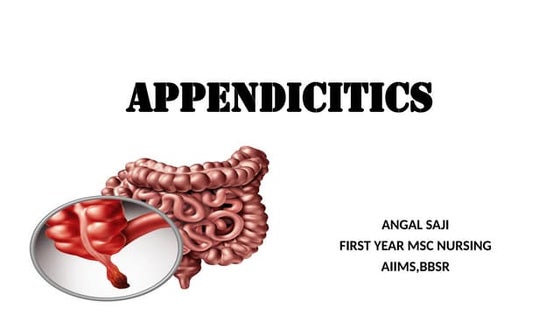 Appendicitis | PPTX