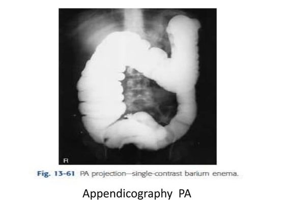 Teknik Pemeriksaan Radiografi Colon In Loop (CIL) | PPTX