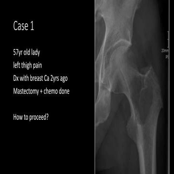 Approach to metastatic bone disease..... | PPTX