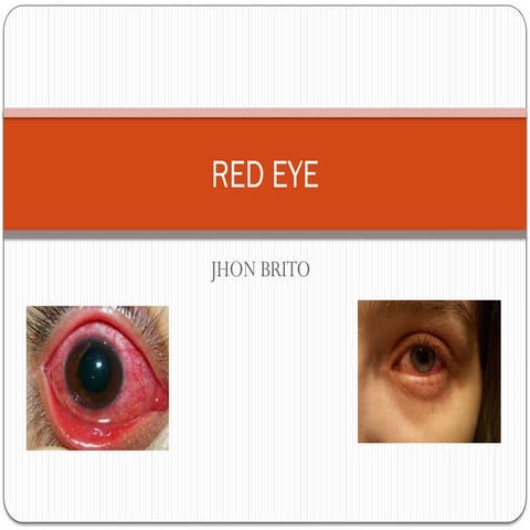 Approach to RED EYE and eye diseases pptx | PPTX
