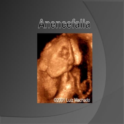 Anencefalia | PPT