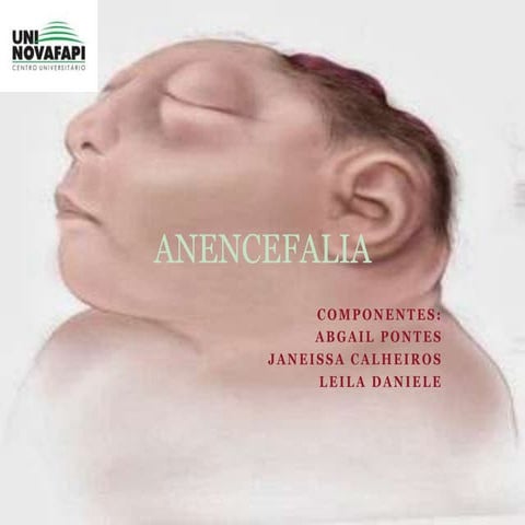 Anencefalia | PPT