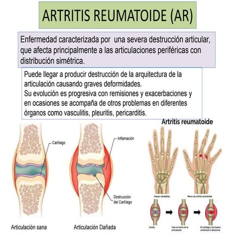 Artritis reumatoide (AR) | PPTX