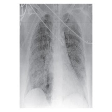 ARDS etio, patho, CF, Dx, Rx of acute resopiratory distress syndrime | PPT