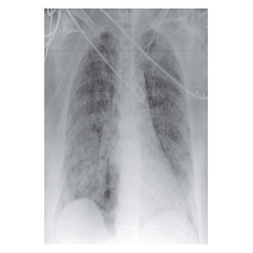 ARDS-acute respiratory distress syndrome | PPT