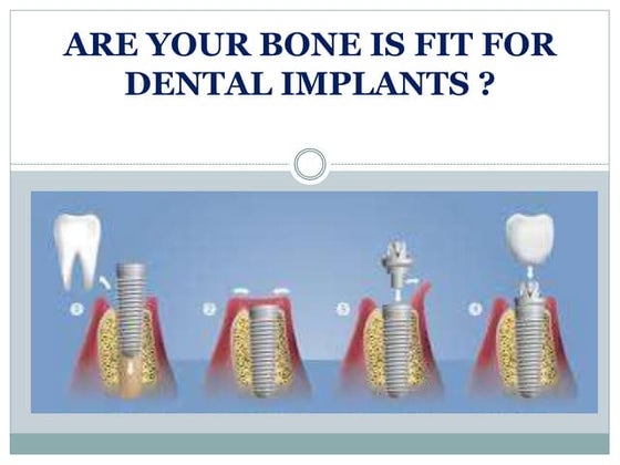 Dental Implants | PPT