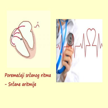 Aritmije | PPTX