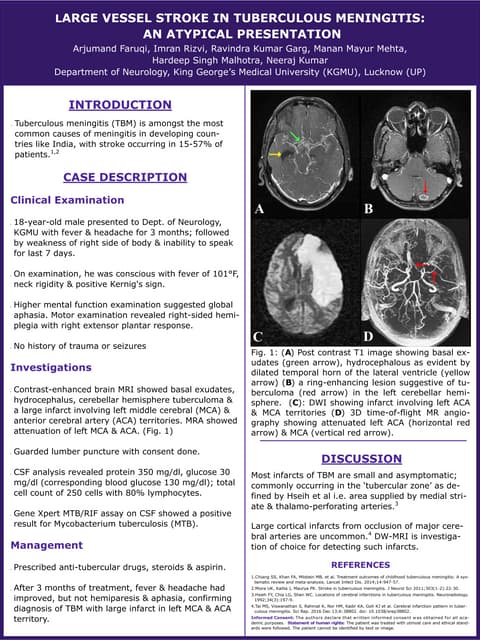 EARLY STROKE IDENTIFICATION USING MICROWAVE HELMET | PPT