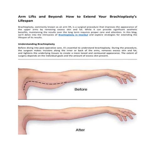 Arm Lifts and Beyond: How to Extend Your Brachioplasty's Lifespan | PPT ...